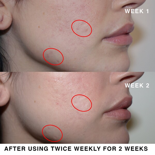 Microneedling Dark Spot Brightening Dots - Peace Out | Sephora