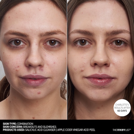 Clogged Pores On Face