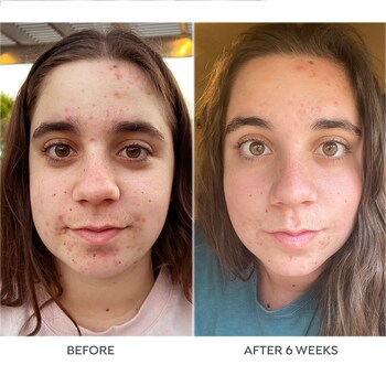 Benzoyl Peroxide Acne Before And After
