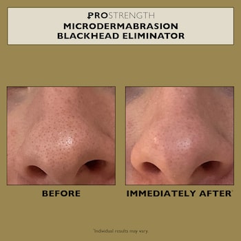 Microdermabrasion Blackheads Before And After