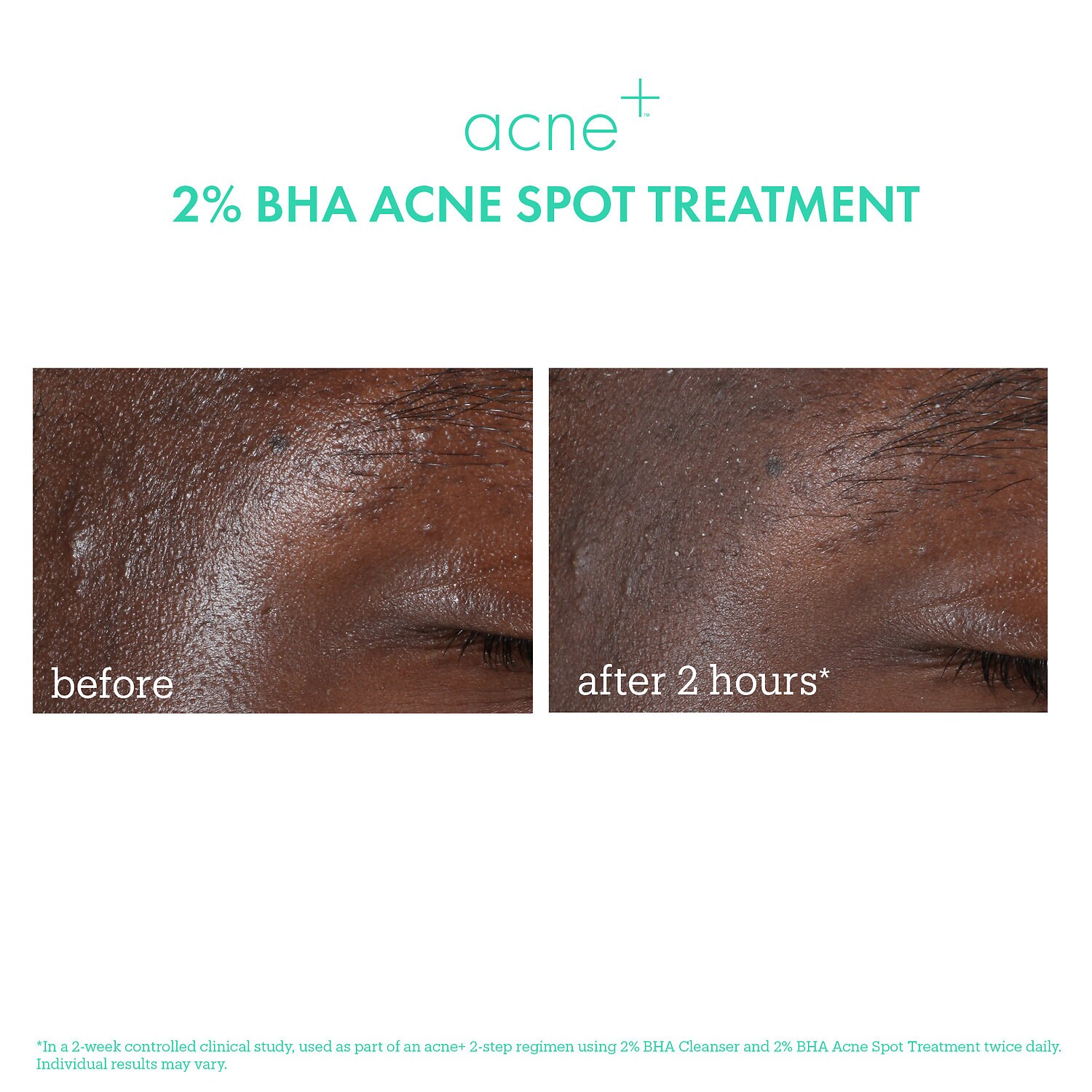 Skinfix Acne+ 2% BHA and Azelaic Acid Acne Spot Treatment | Mall of ...