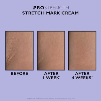 Stretch Marks Cream Before And After
