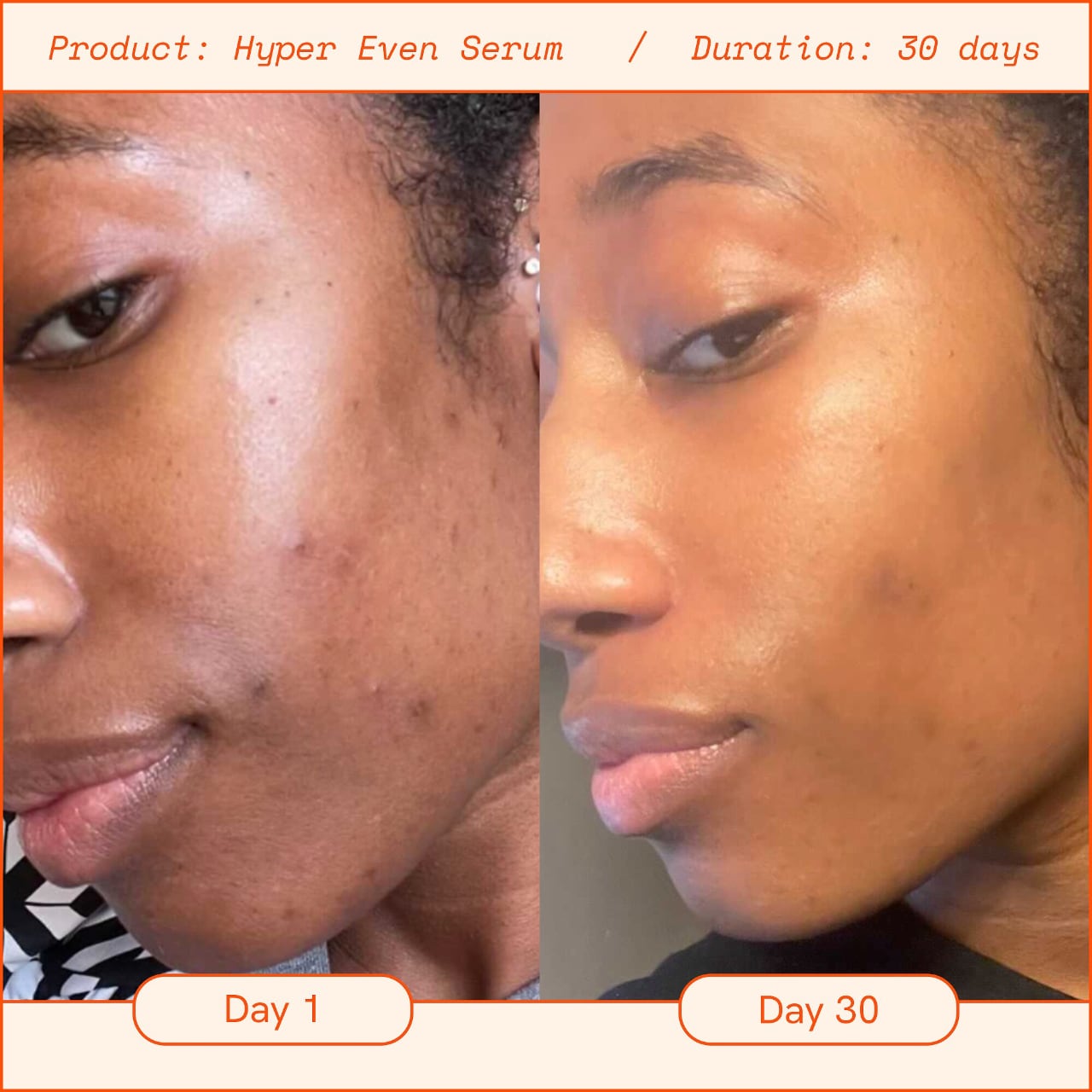 Hyperpigmentation Face