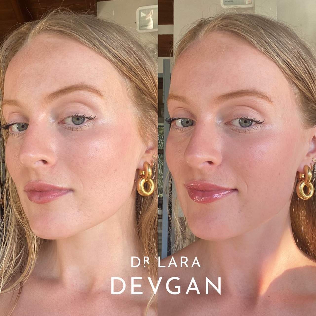 Dr. Lara Devgan Scientific Beauty Platinum Lip Plump SPF 30 | Mall of ...